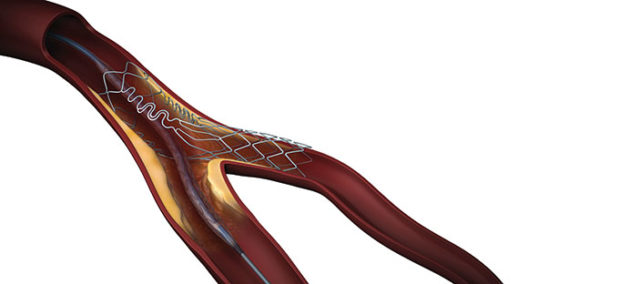 First US commercial case performed using Tryton Side branch stent - Cardiovascular News