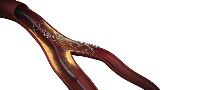 First US commercial case performed using Tryton Side branch stent - Cardiovascular News