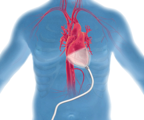 EpicHeart soft-robotic heart assist device wins innovation award - CN