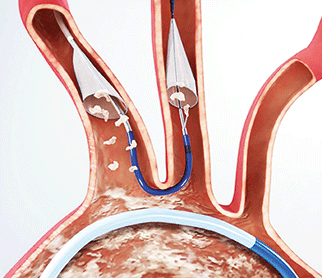 ADVERTORIAL: Sentinel Cerebral Protection System provides reassurance ...