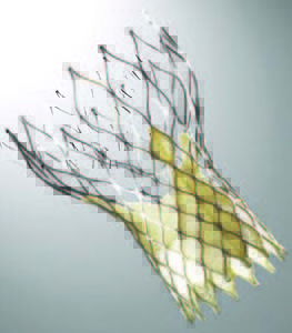 Safety and efficacy of valve-in-valve procedures with CoreValve confirmed