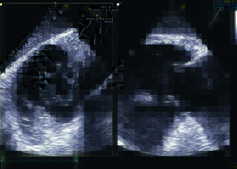 ADVERTORIAL: Tricuspid annular reduction using Cardioband Tricuspid