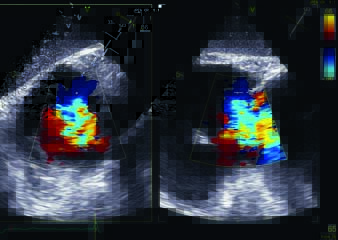 ADVERTORIAL: Tricuspid annular reduction using Cardioband Tricuspid