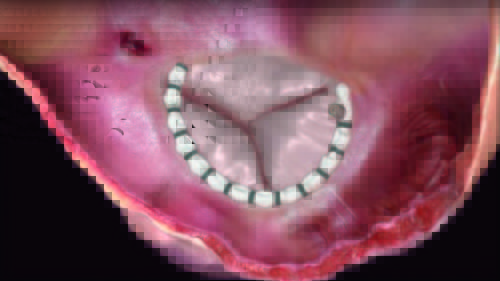 ADVERTORIAL: Tricuspid annular reduction using Cardioband Tricuspid