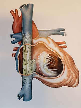 The Tricento valve: A novel approach for tricuspid regurgitation