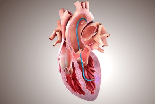 THT 2026: Autologous cell therapy may curb pathological ventricular ...
