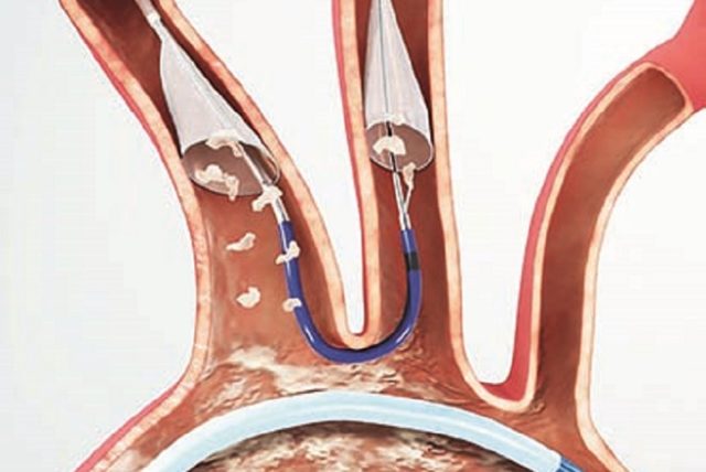 NICE issues recommendations on insertion of cerebral protection devices ...