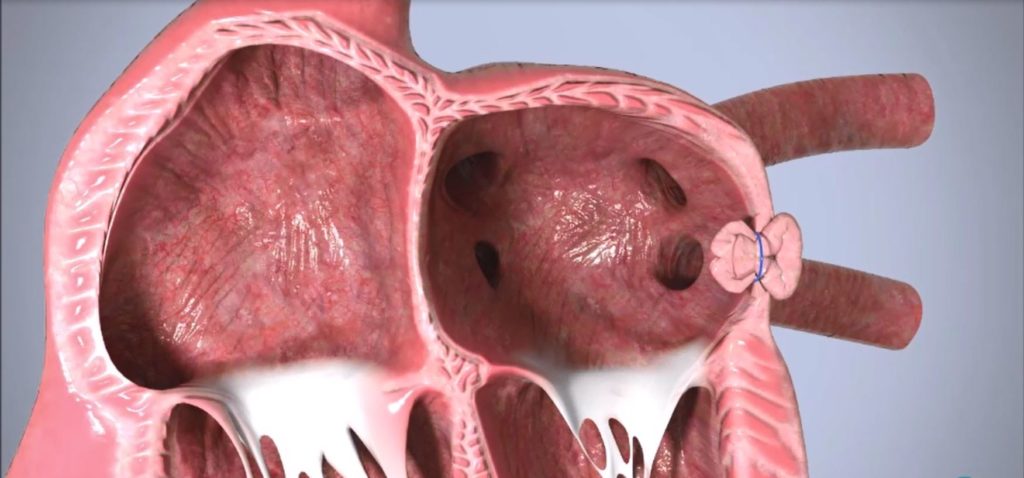 Append Medical share clinical proof-of-concept results for internal ...