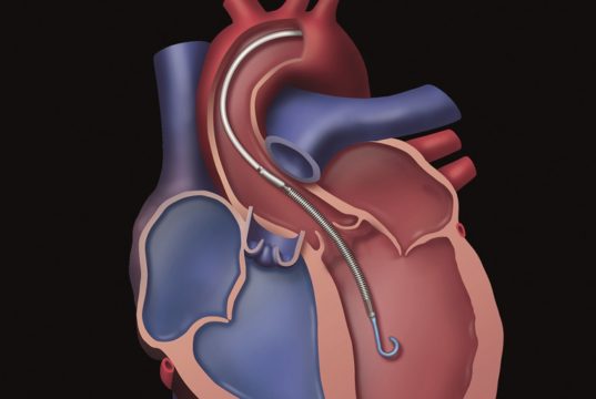 Japanese study finds high survival rates with use of Impella heart pump