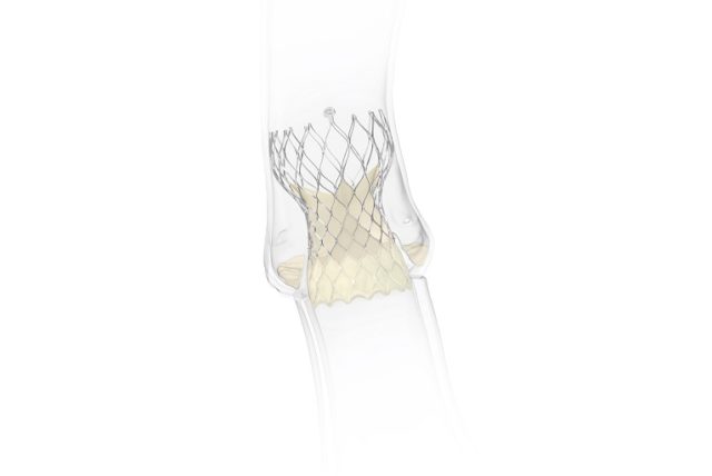 Medtronics Evolut Pro Tavi System Gains Ce Mark Cardiovascular News