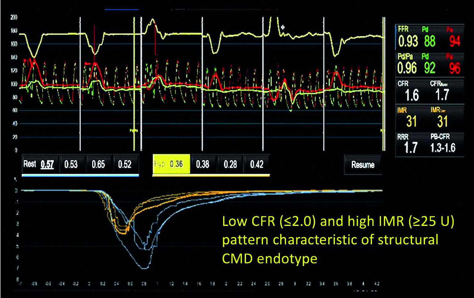 Assessing non-obstructive coronary disease in the cath lab: A tailored ...