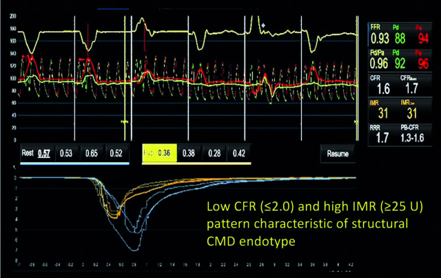 Assessing non-obstructive coronary disease in the cath lab: A tailored ...