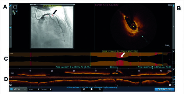 The benefits of optical coherence tomography in the cath lab ...