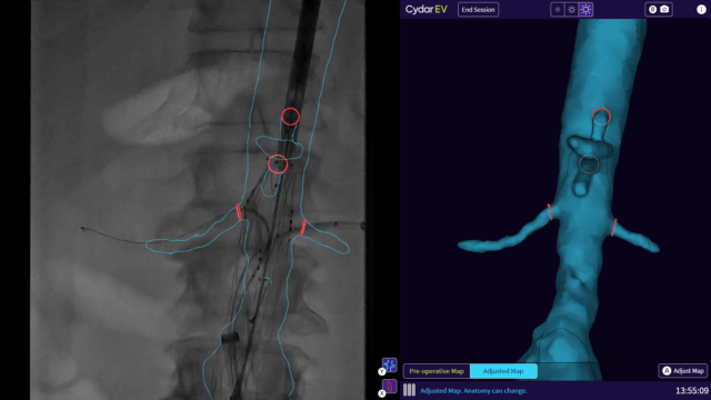 Philips integrates cloud-based AI and 3D mapping into Zenition system