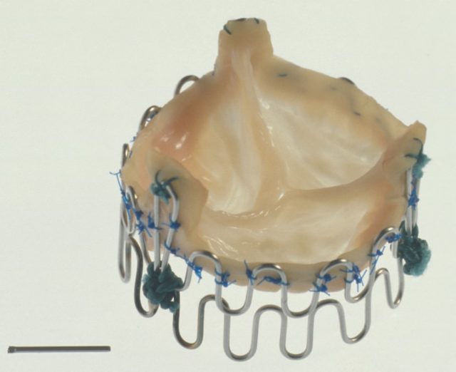 “TAVI was my baby, now it is a teenager”