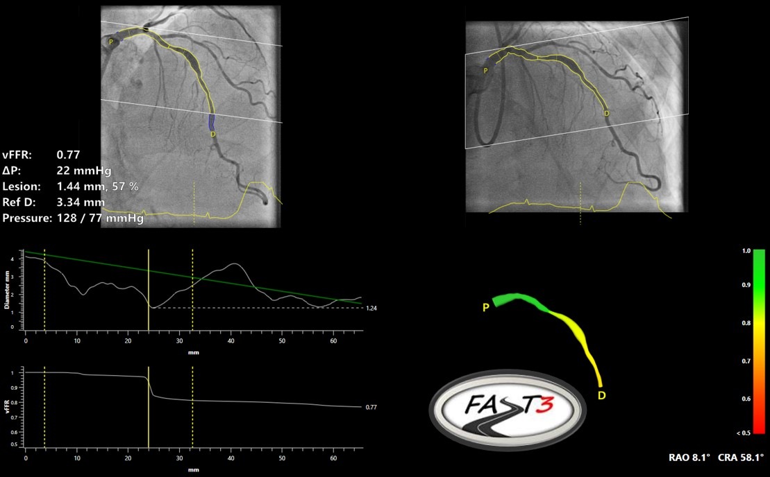 Enrolment milestone reached in trial of angiography-based vessel ...