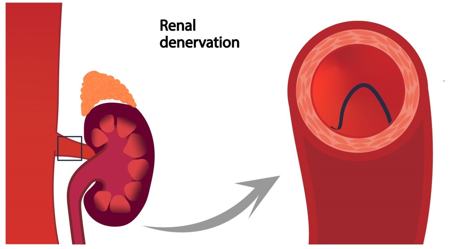 CMS recommends coverage for renal denervation for hypertension ...
