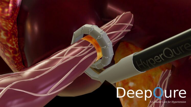 DeepQure receives IDE approval of extravascular renal denervation ...