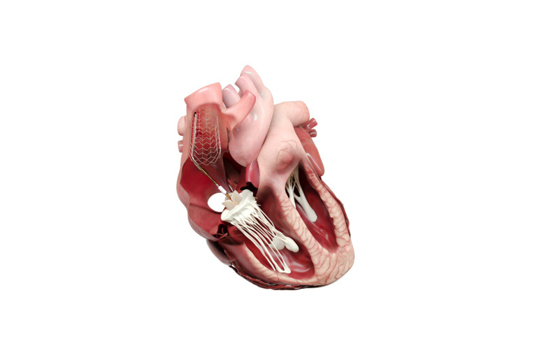First patients treated with Duo tricuspid coaptation system in TANDEM ...