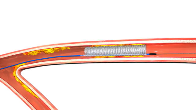 Ringer perfusion balloon catheter gains US FDA approval
