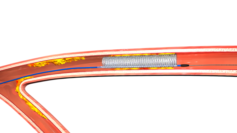 Ringer perfusion balloon catheter gains US FDA approval