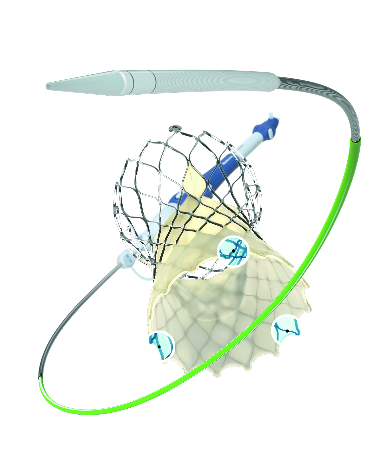 Evolut TAVI systems gain US FDA approval for redo-TAVI procedures ...