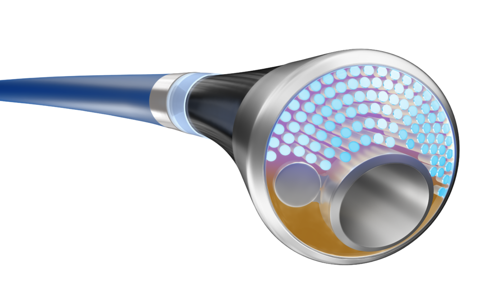 First patient enrolled in study of integrated laser atherectomy and IVL ...