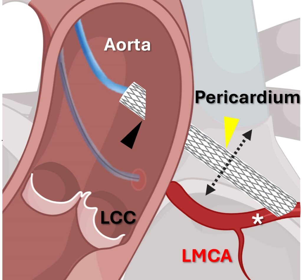 First-in-man VECTOR procedure offers new approach for preventing ...